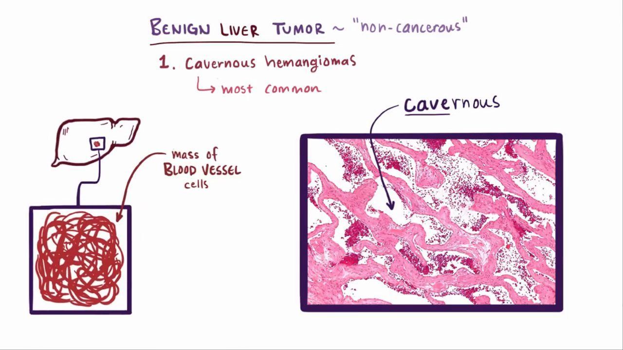Video: Benign liver tumors | Osmosis