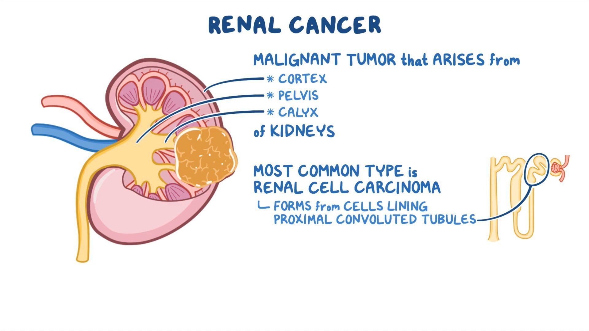 Video Renal Cancer Nursing