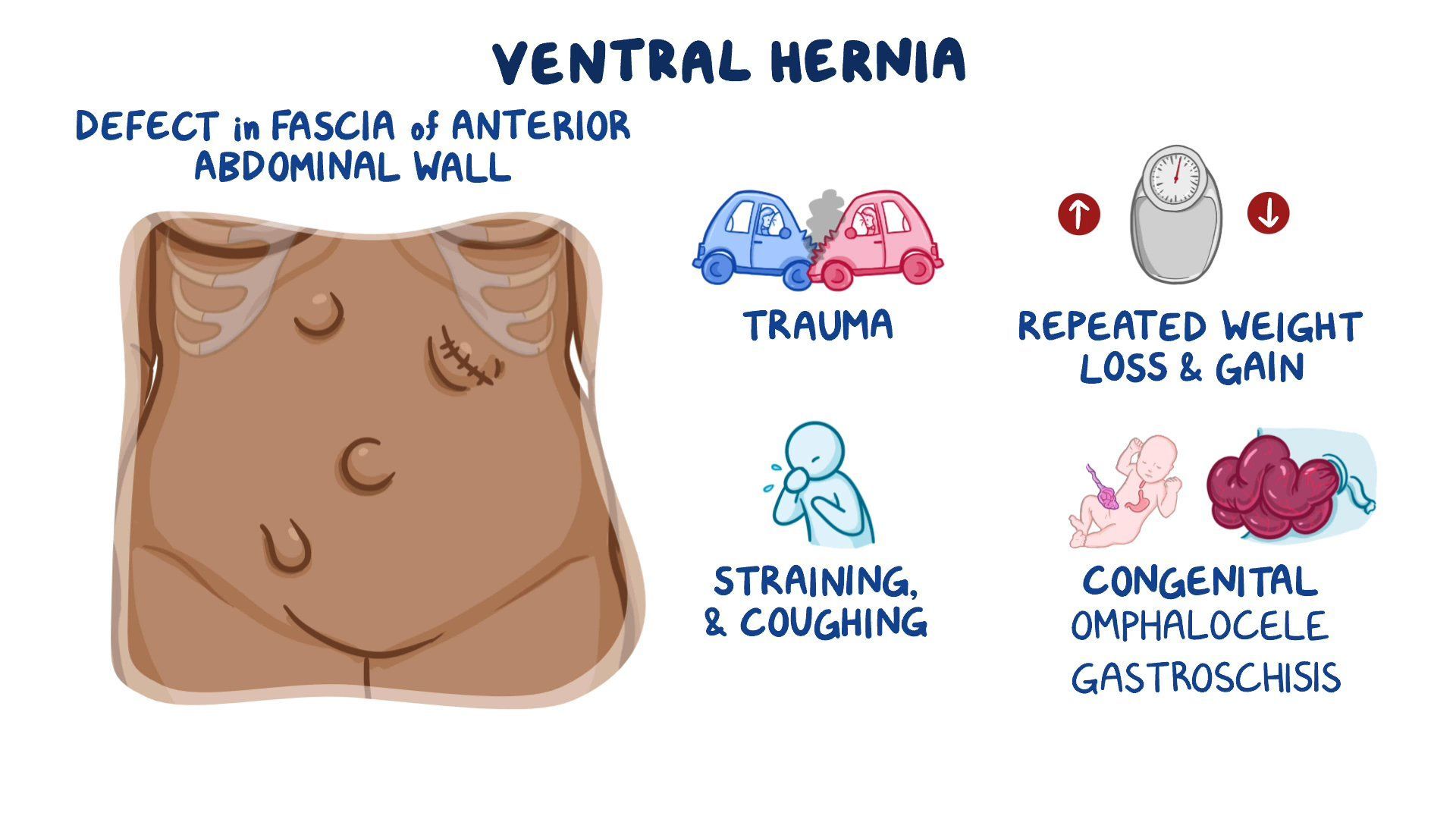 Video: Ventral and incisional hernias: Clinical sciences | Osmosis