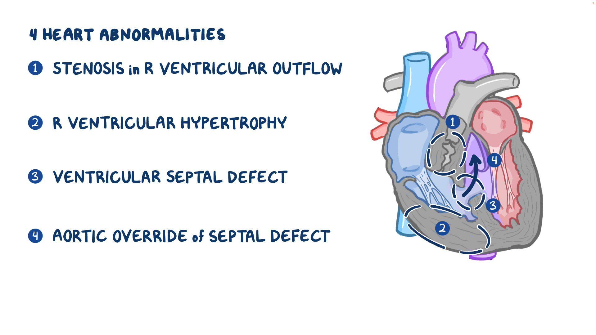 Famous People Who Have Tetralogy Fallot