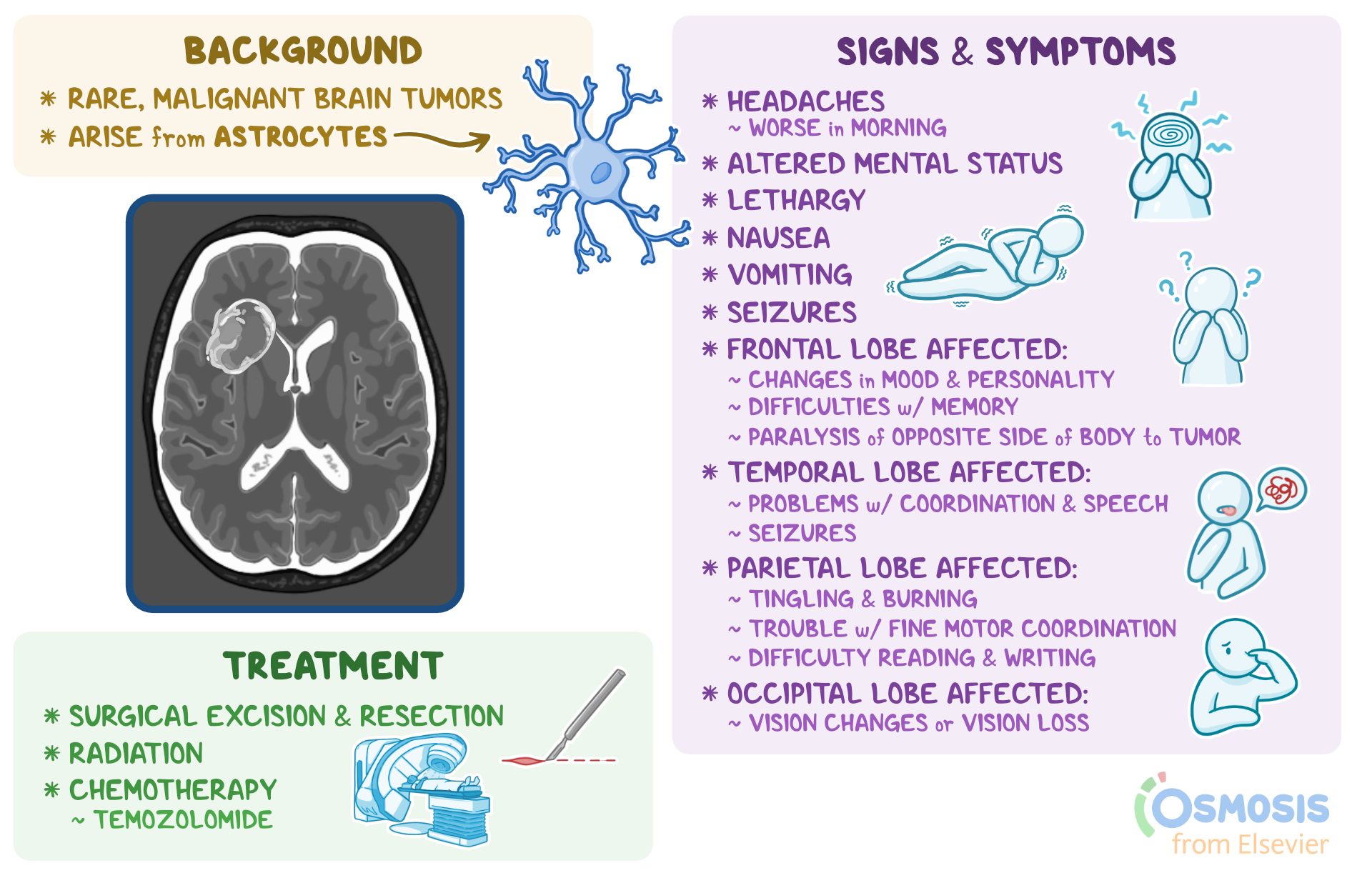 Anaplastic Astrocytoma: What Is It, Causes, Signs, and More | Osmosis
