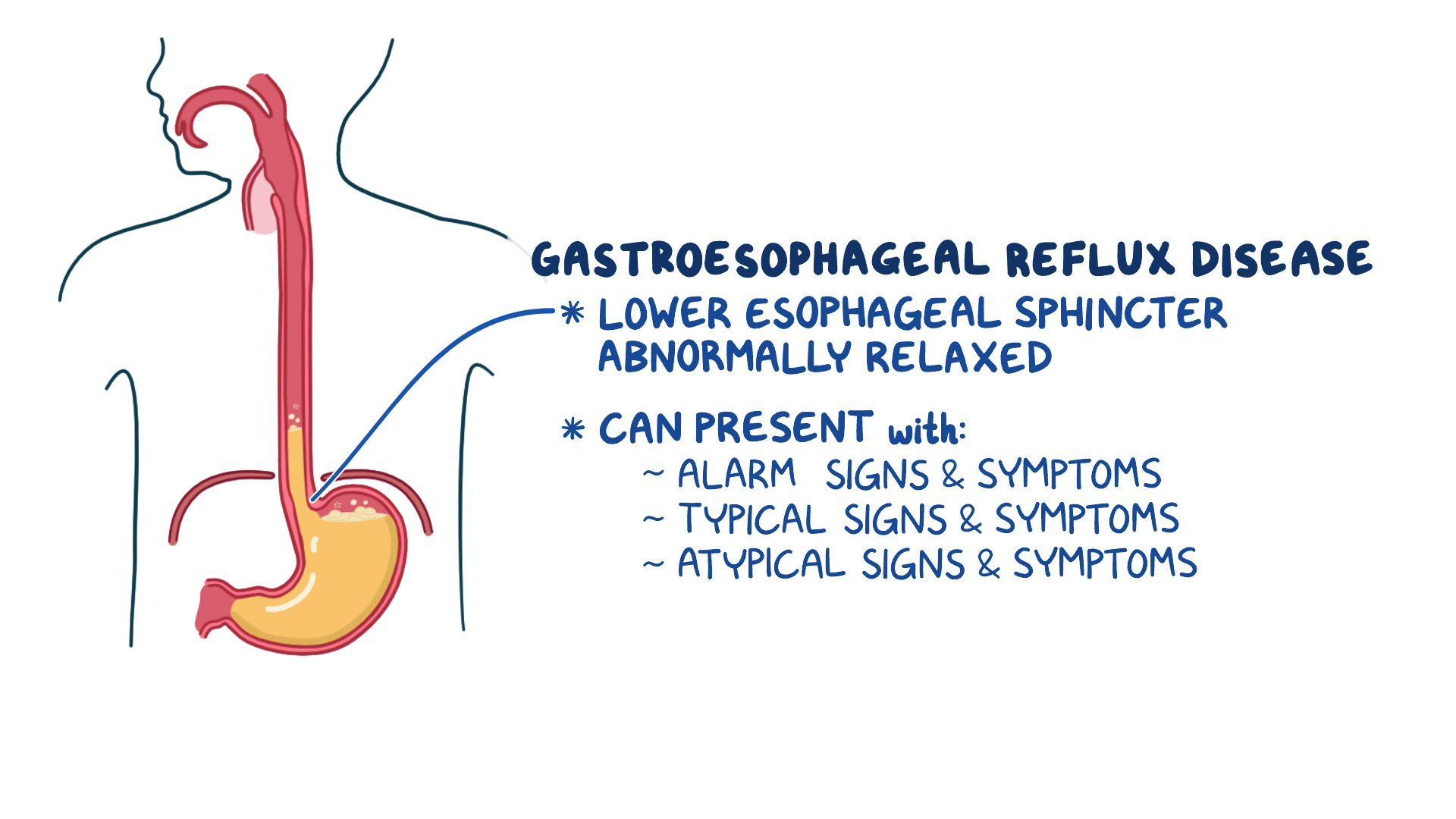 Video: Gastroesophageal reflux disease: Clinical sciences | Osmosis