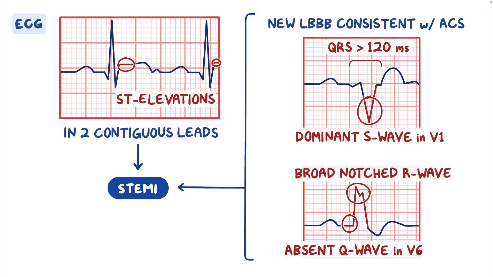 Video Acute Coronary Syndrome Clinical Sciences Osmosis Video Acute Coronary Syndrome Clinical Sciences Osmosis