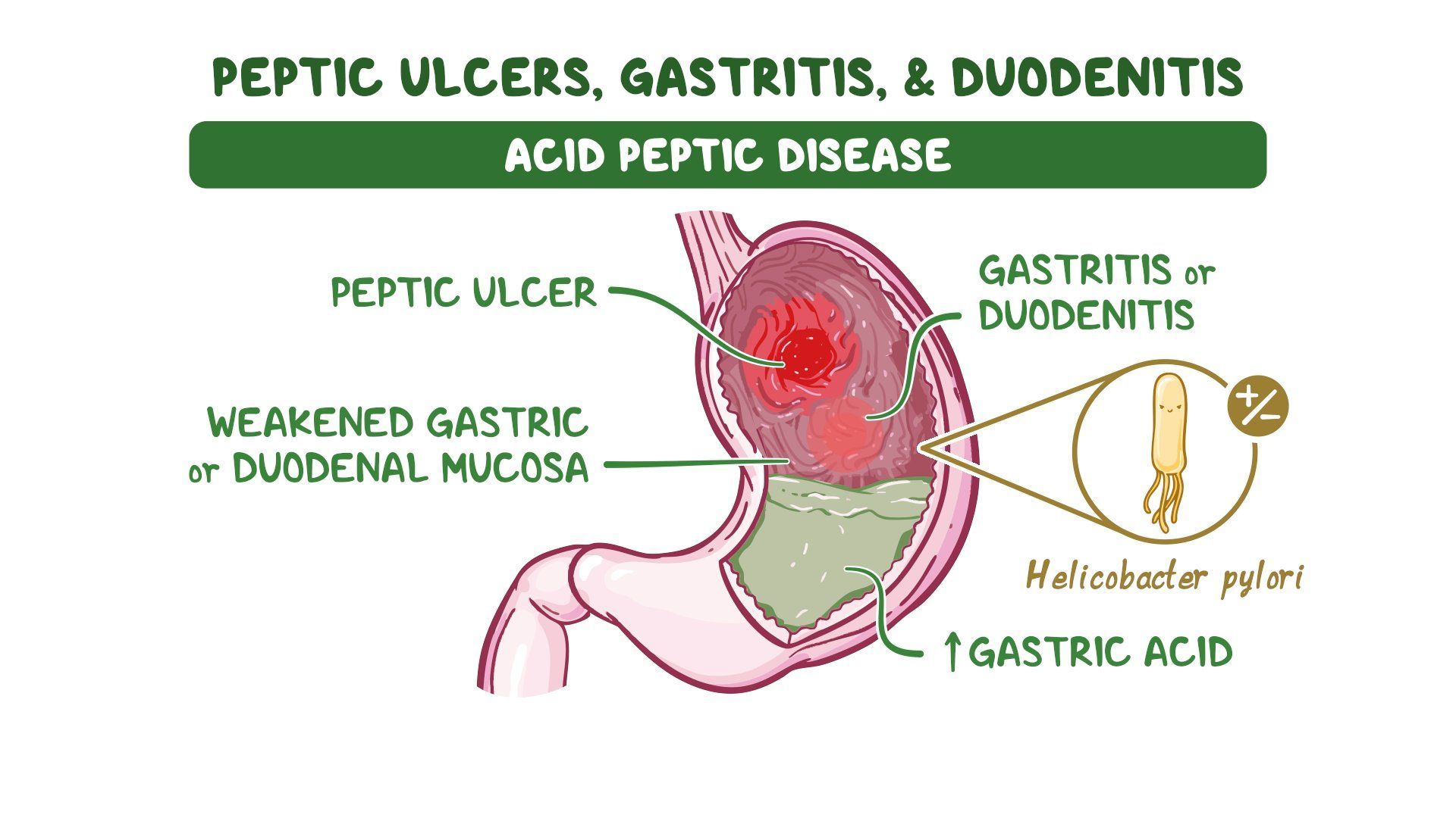 Video: Peptic ulcers, gastritis, and duodenitis (pediatrics): Clinical ...