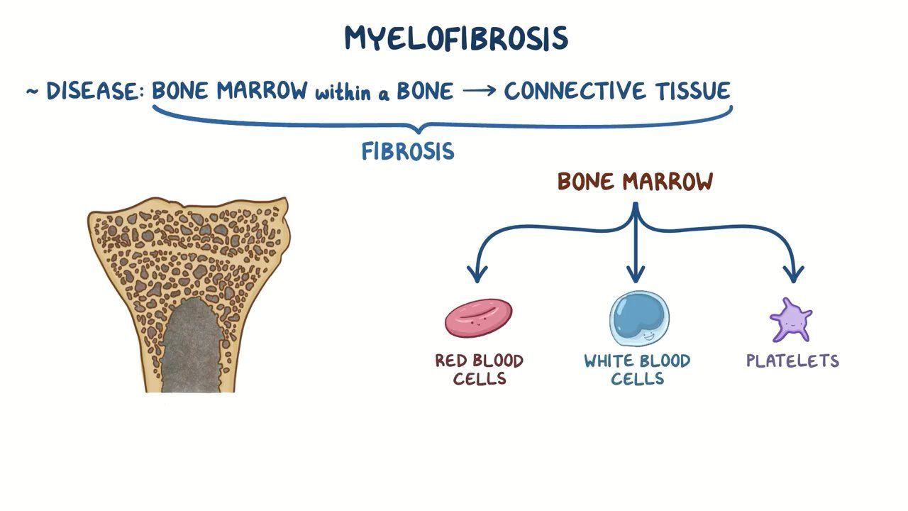 Video: Myelofibrosis (NORD) | Osmosis