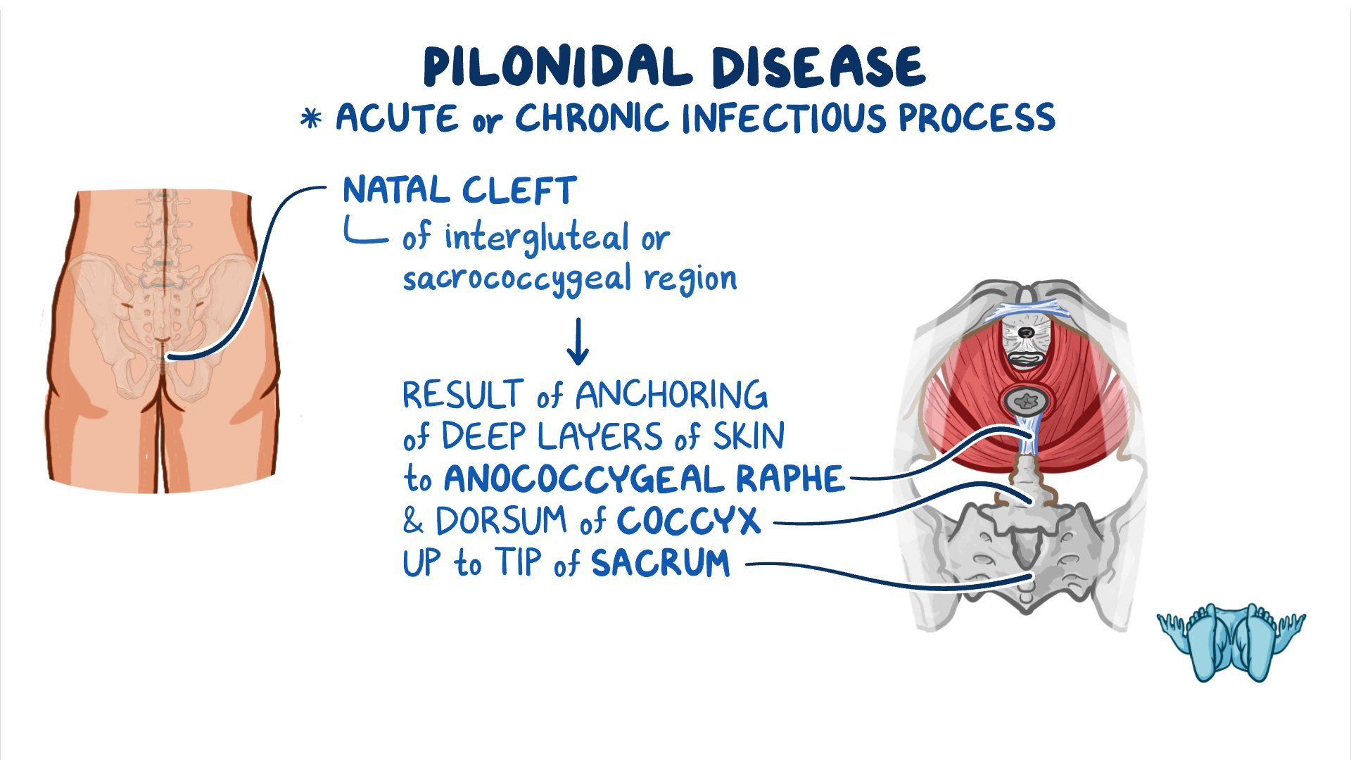 Video Pilonidal Disease Clinical Sciences Osmosis Video Pilonidal Disease Clinical Sciences Osmosis