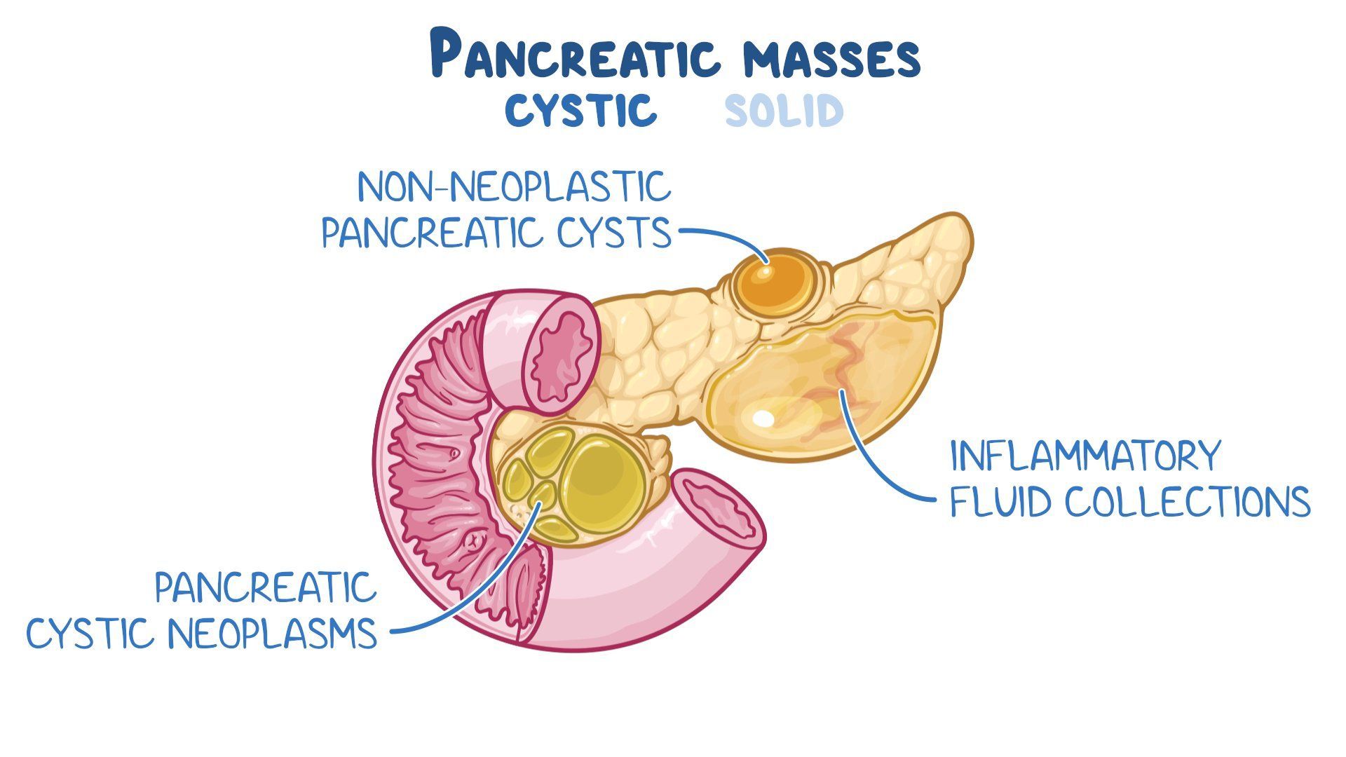 Video Approach To Pancreatic Masses Clinical Sciences Osmosis Video Approach To Pancreatic Masses Clinical Sciences Osmosis