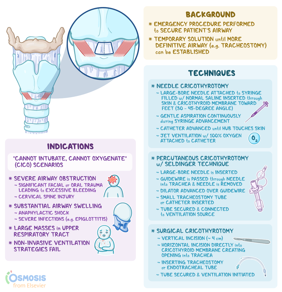 Cricothyrotomy: What Is It, Indications, How It?s Done, and More | Osmosis