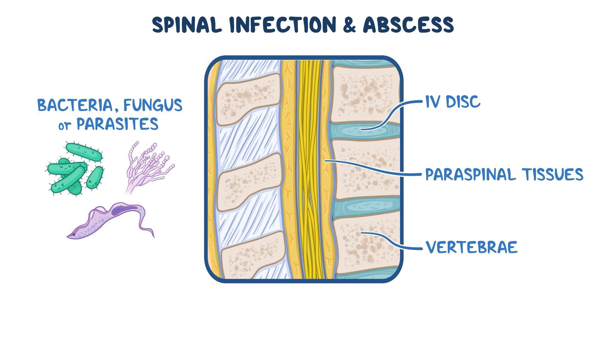 Video: Spinal infection and abscess: Clinical sciences | Osmosis