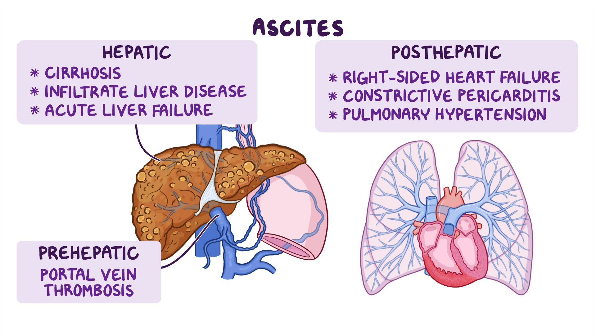 Video: Approach to ascites: Clinical sciences | Osmosis