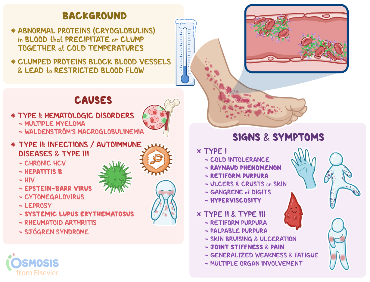 Cryoglobulinemia: What Is It, Causes, Symptoms, and More | Osmosis