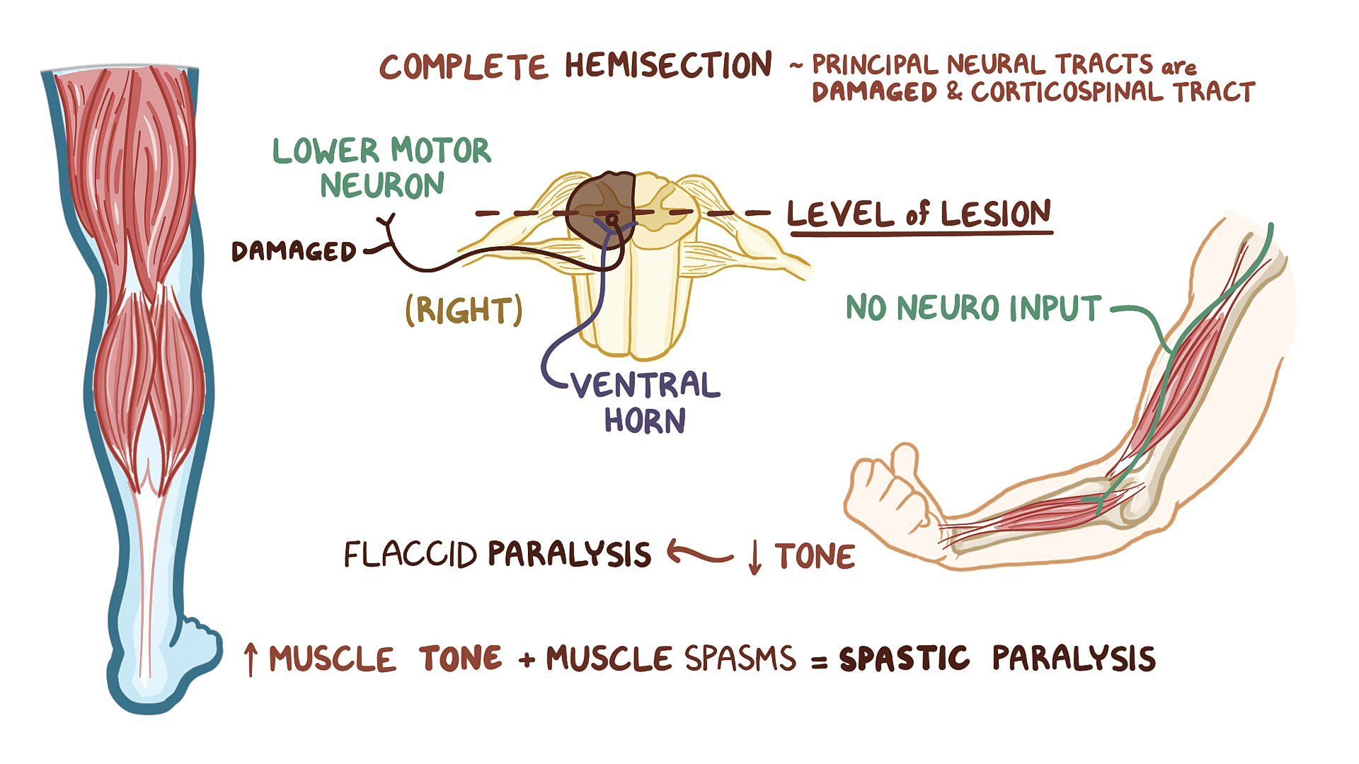 Video: Brown-Sequard Syndrome | Osmosis