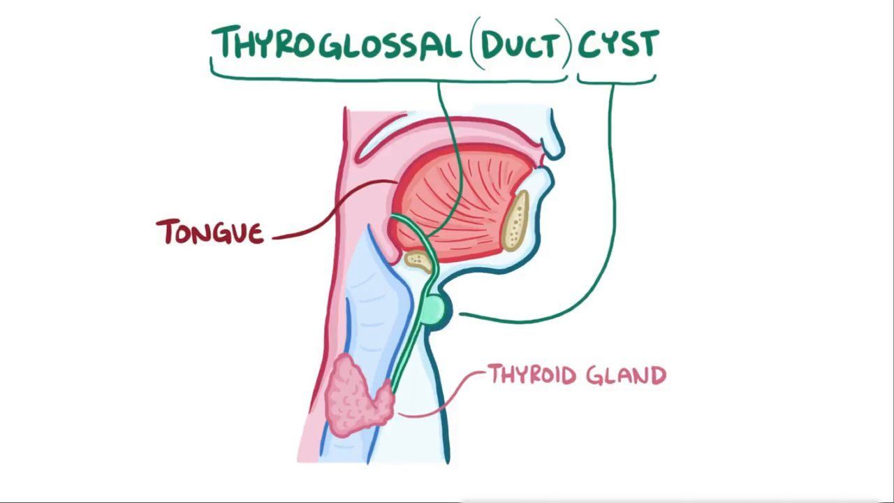 Video: Thyroglossal duct cyst | Osmosis