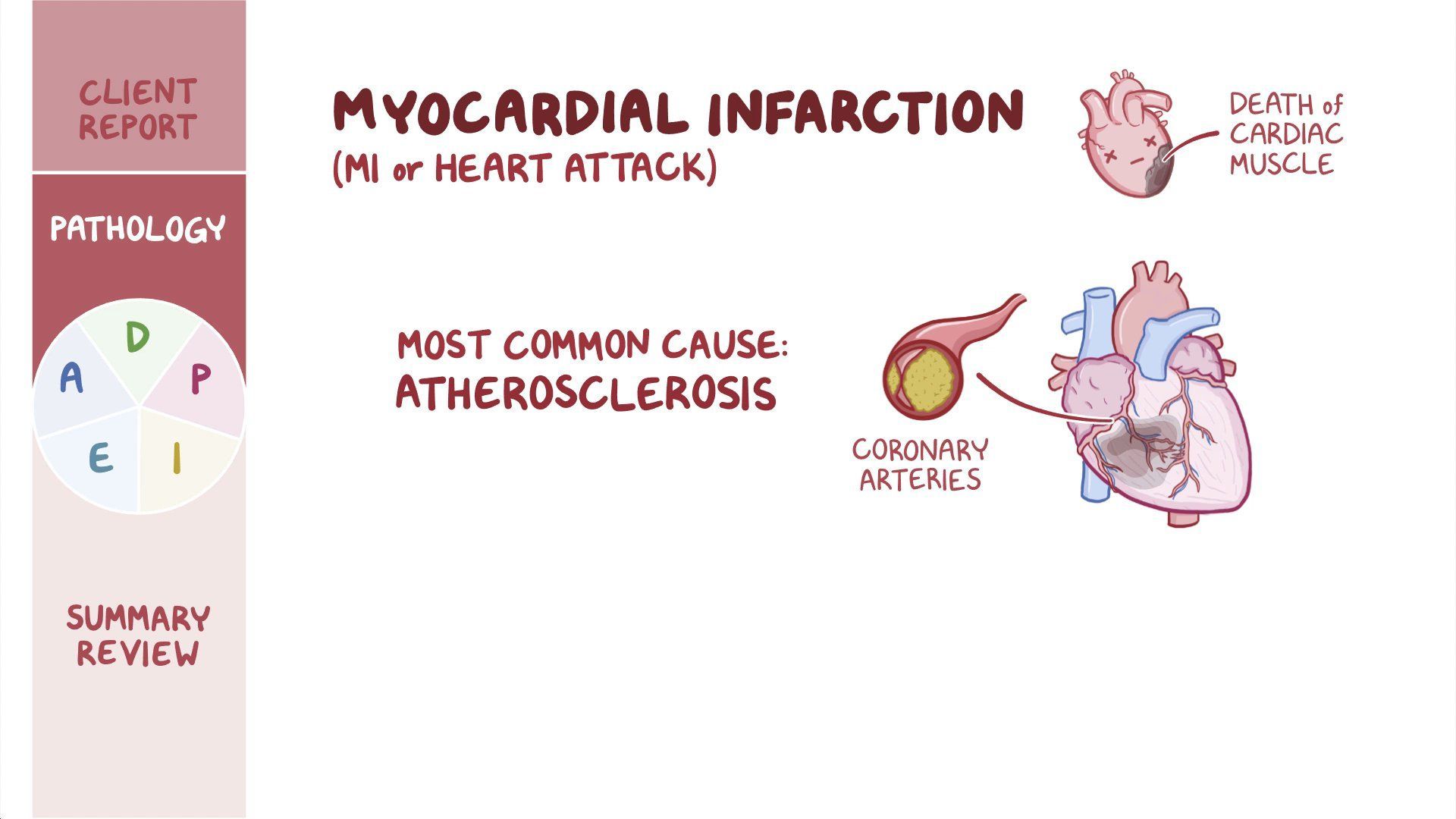 Video: Myocardial infarction (MI): Nursing process (ADPIE) | Osmosis