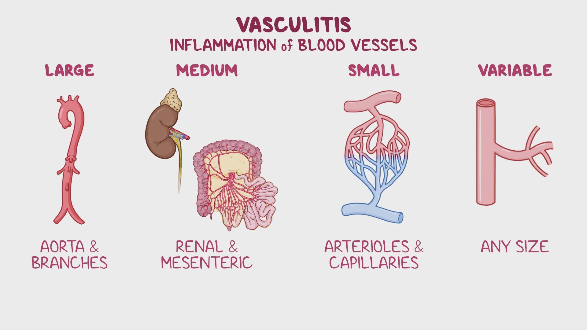 Video: Approach to vasculitis: Clinical sciences | Osmosis