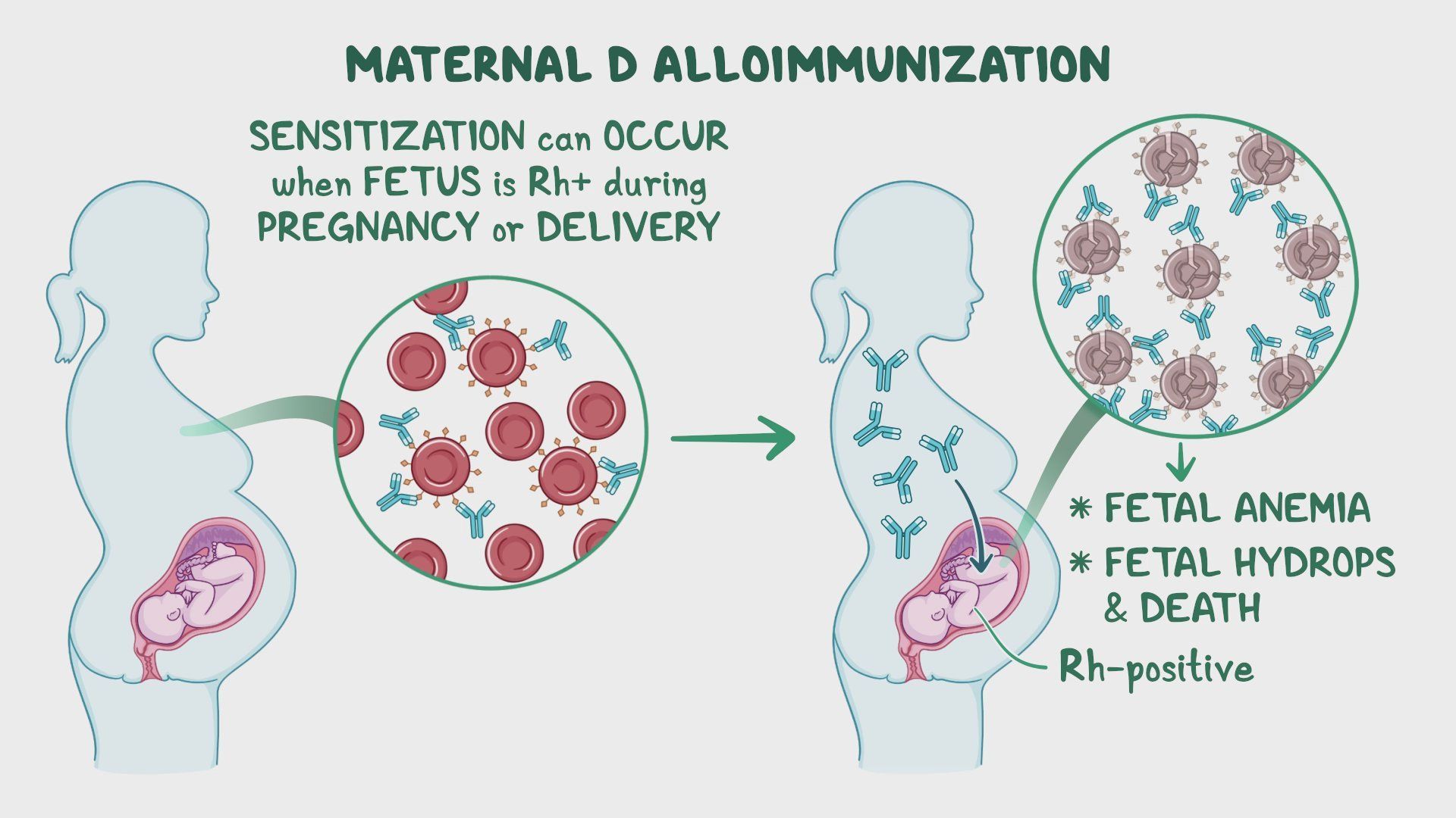 Video: Maternal D alloimmunization (prevention): Clinical sciences ...