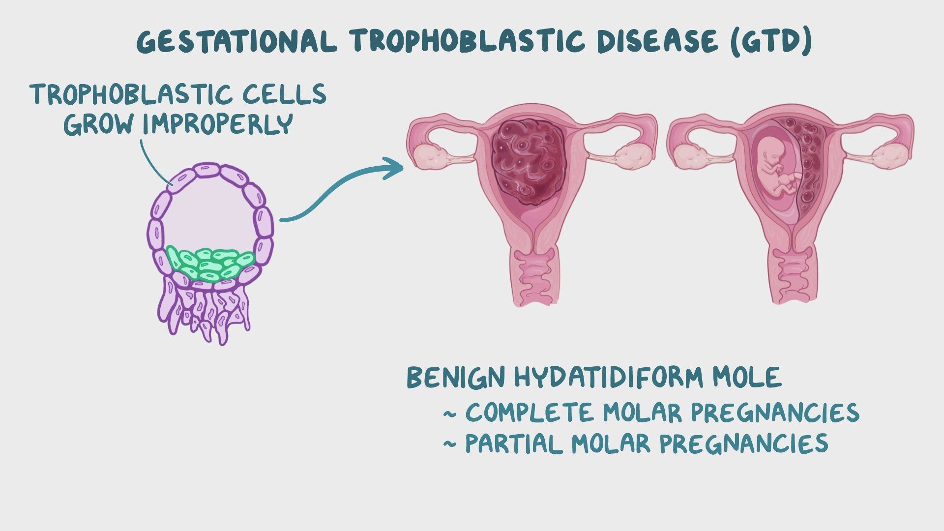 Video: Gestational trophoblastic disease (GTD) and neoplasia (GTN ...