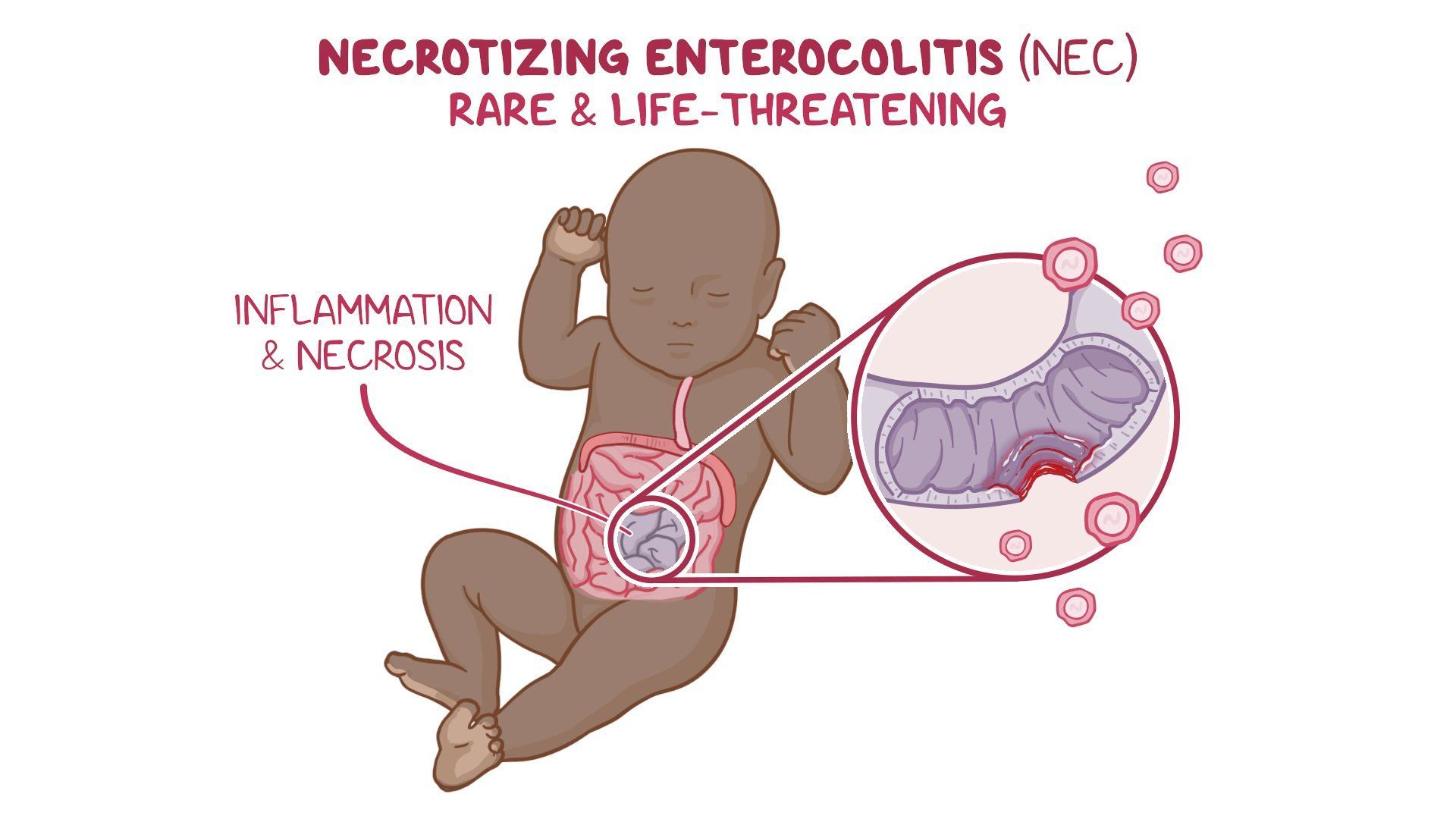 Necrotizing Enterocolitis