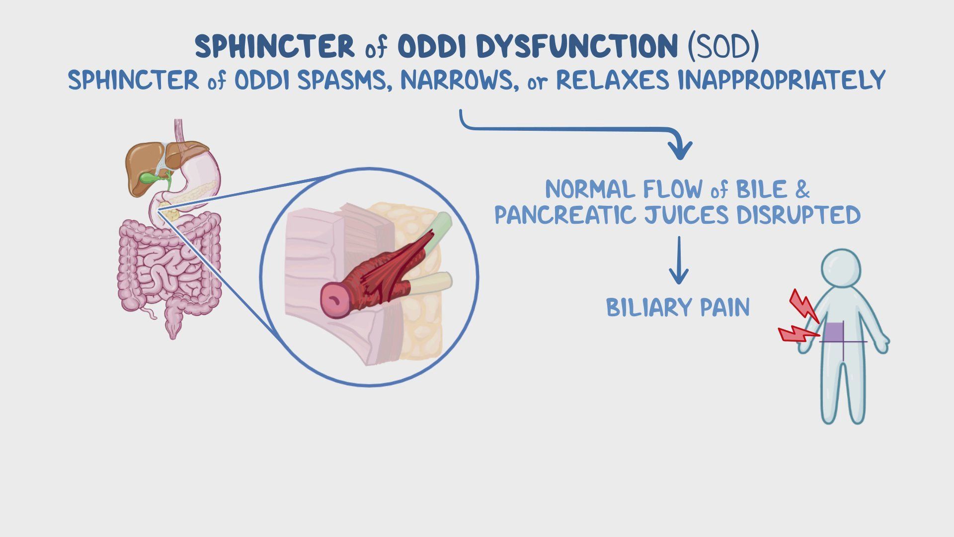 Video: Sphincter of Oddi dysfunction: Year of the Zebra 2024 | Osmosis