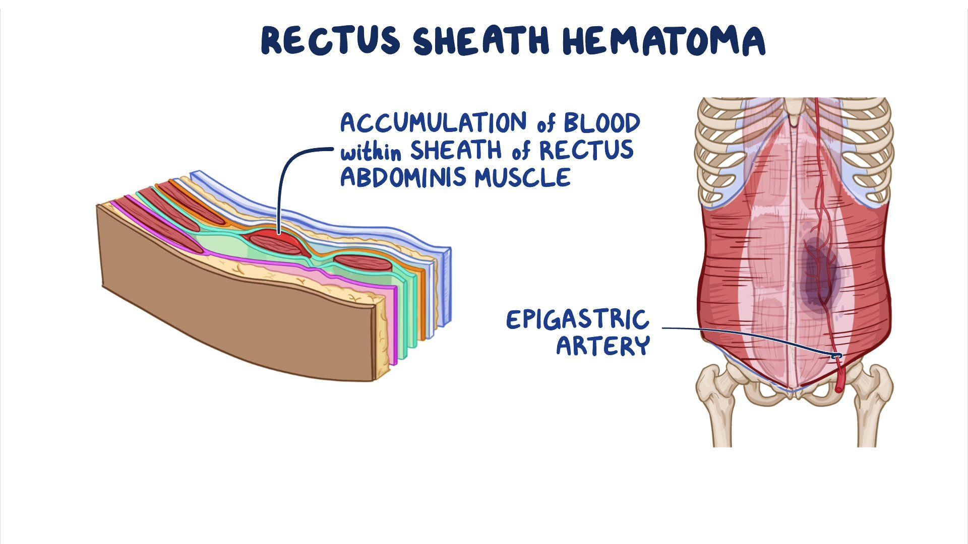 Video: Rectus sheath hematoma: Clinical sciences | Osmosis
