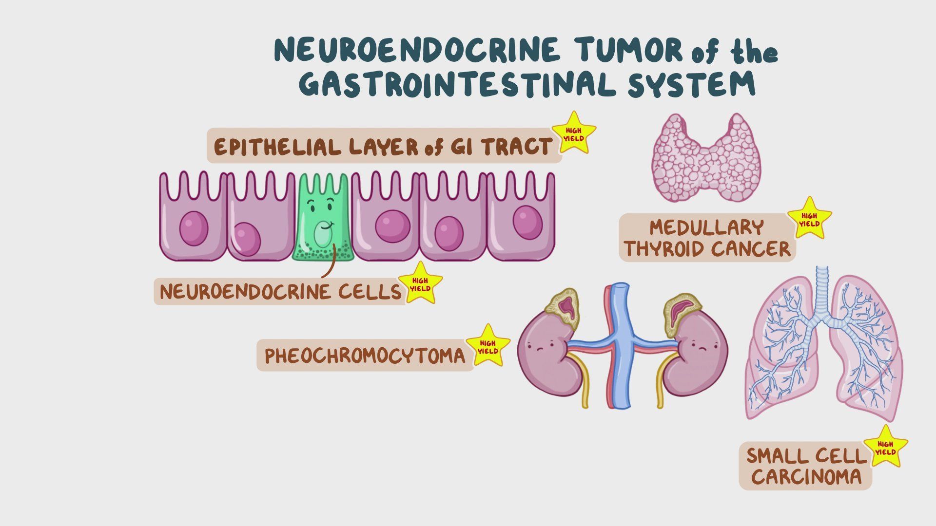 Video: Neuroendocrine tumors of the gastrointestinal system: Pathology ...