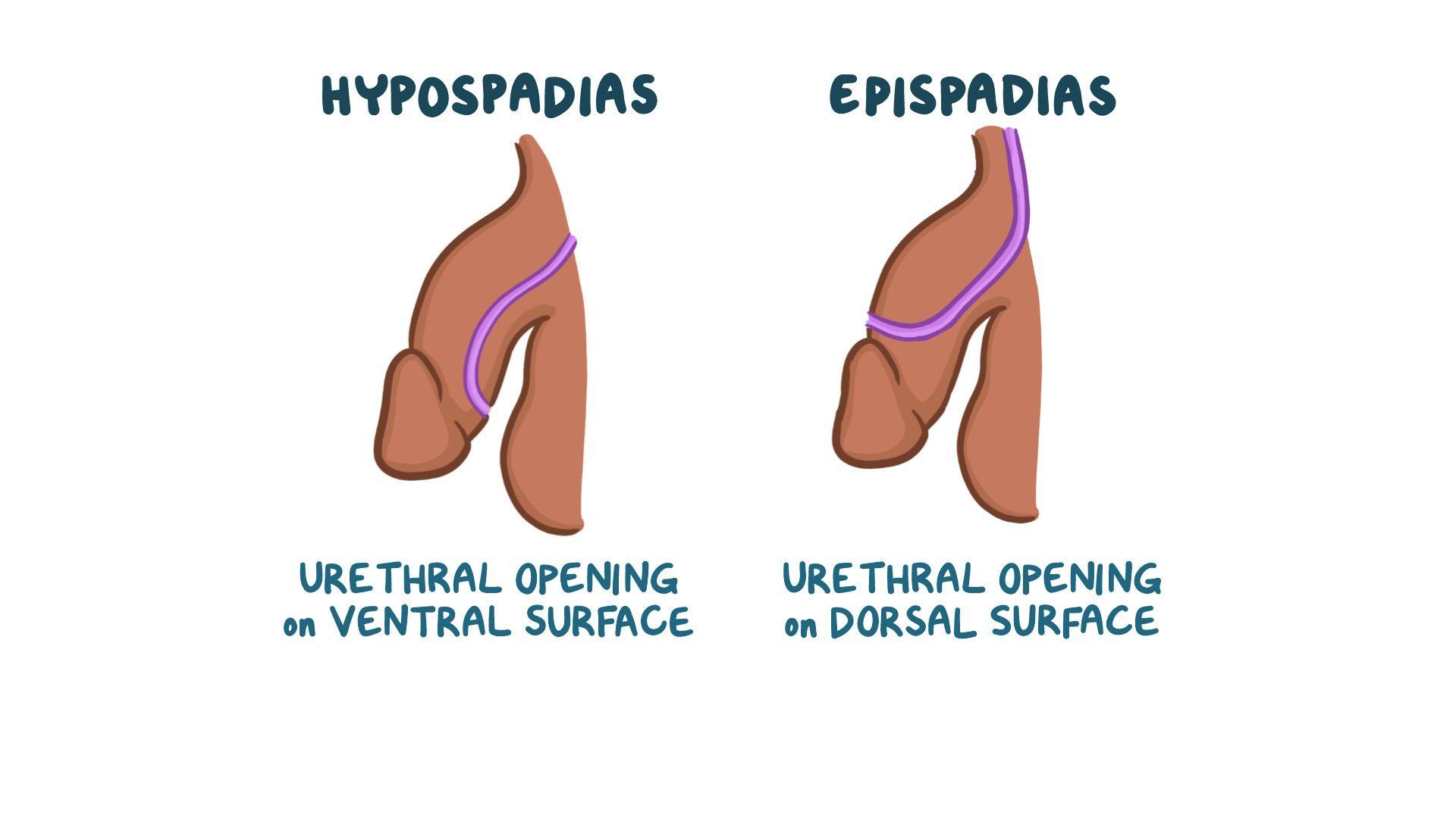 Video Hypospadias And Epispadias Nursing Osmosis