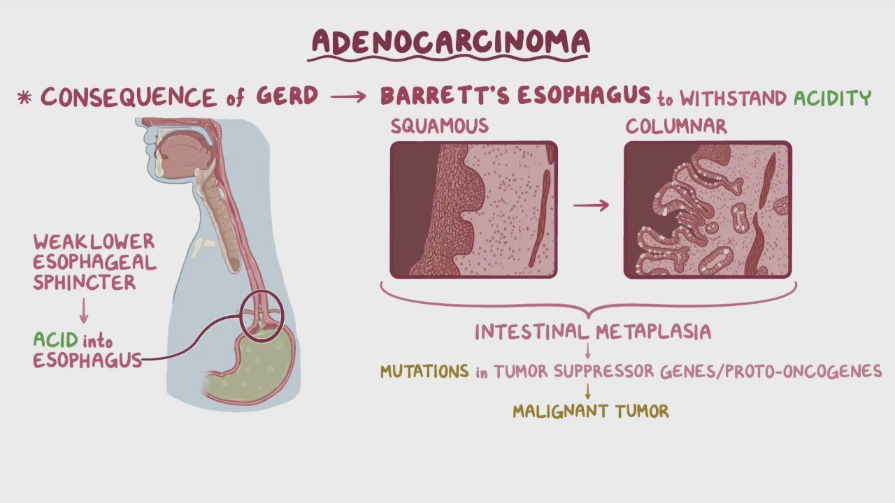Video: Esophageal cancer: Year of the Zebra | Osmosis