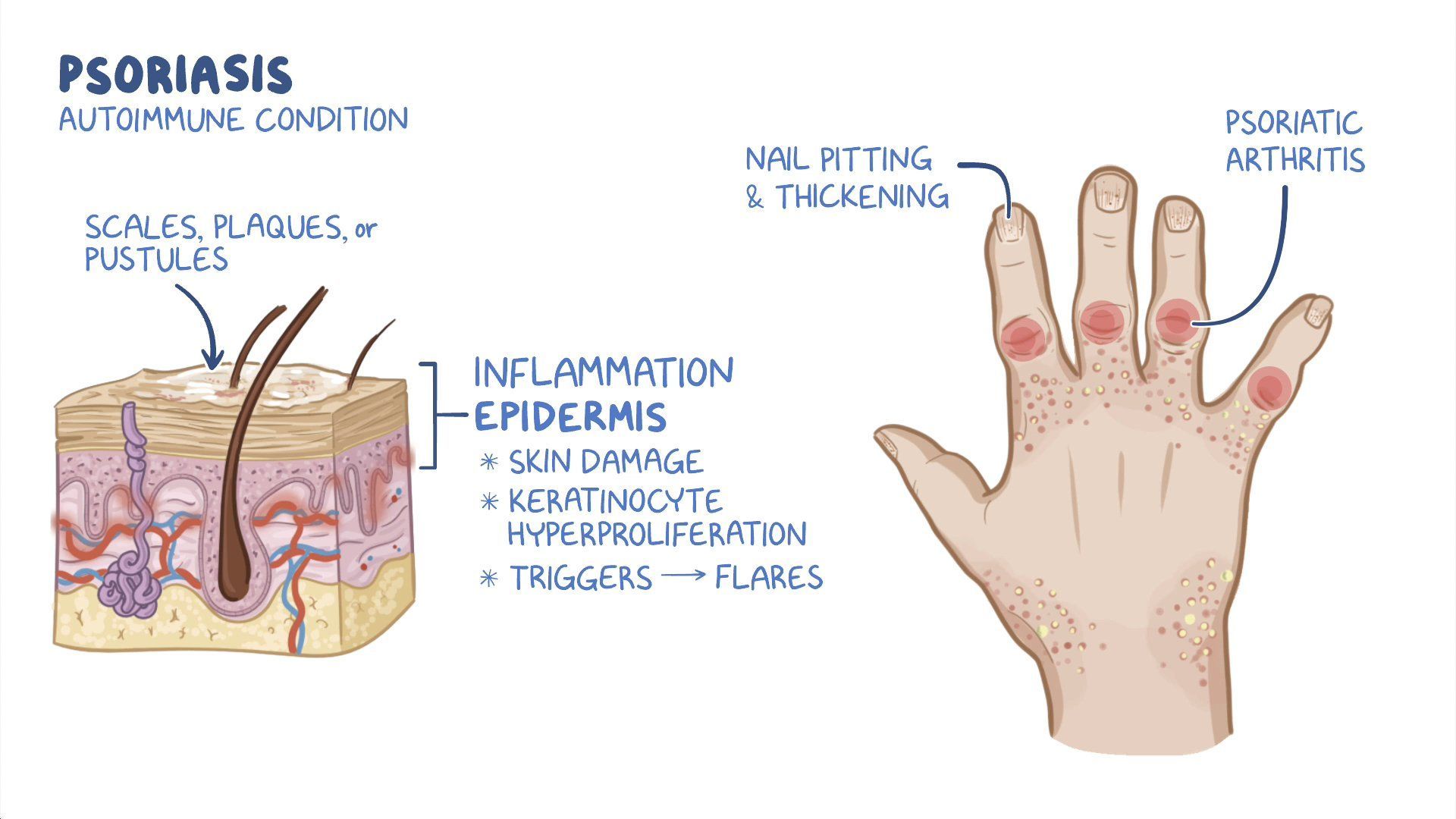 Video: Psoriasis: Nursing | Osmosis