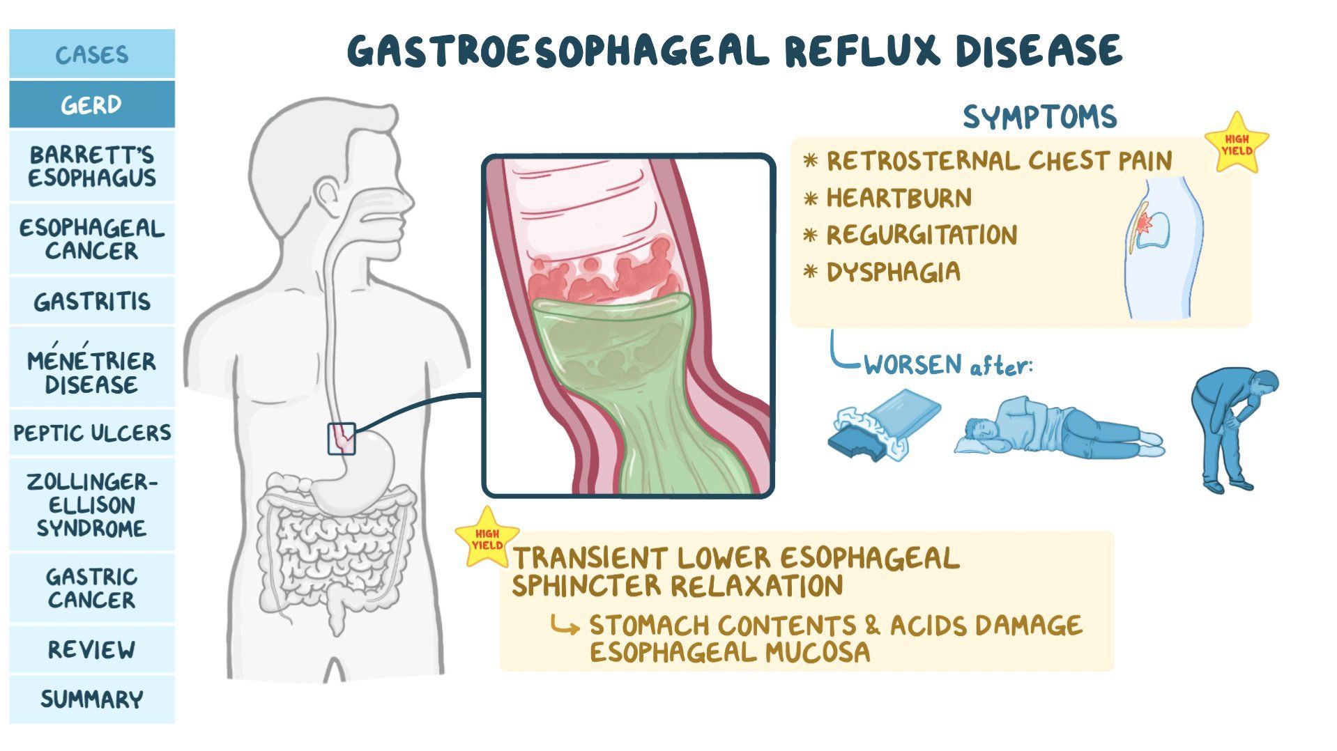 Video: GERD, peptic ulcers, gastritis, and stomach cancer: Pathology ...