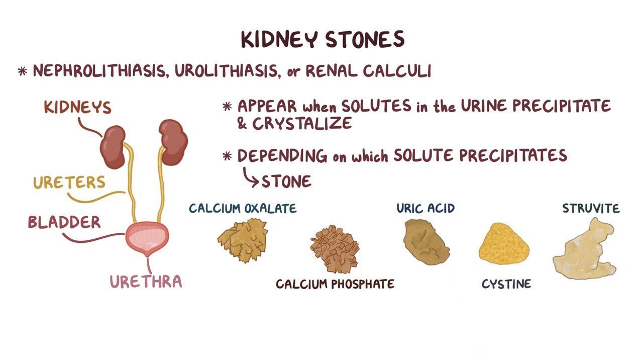 Clinical Reasoning Kidney Stones Osmosis Clinical Reasoning Kidney Stones Osmosis