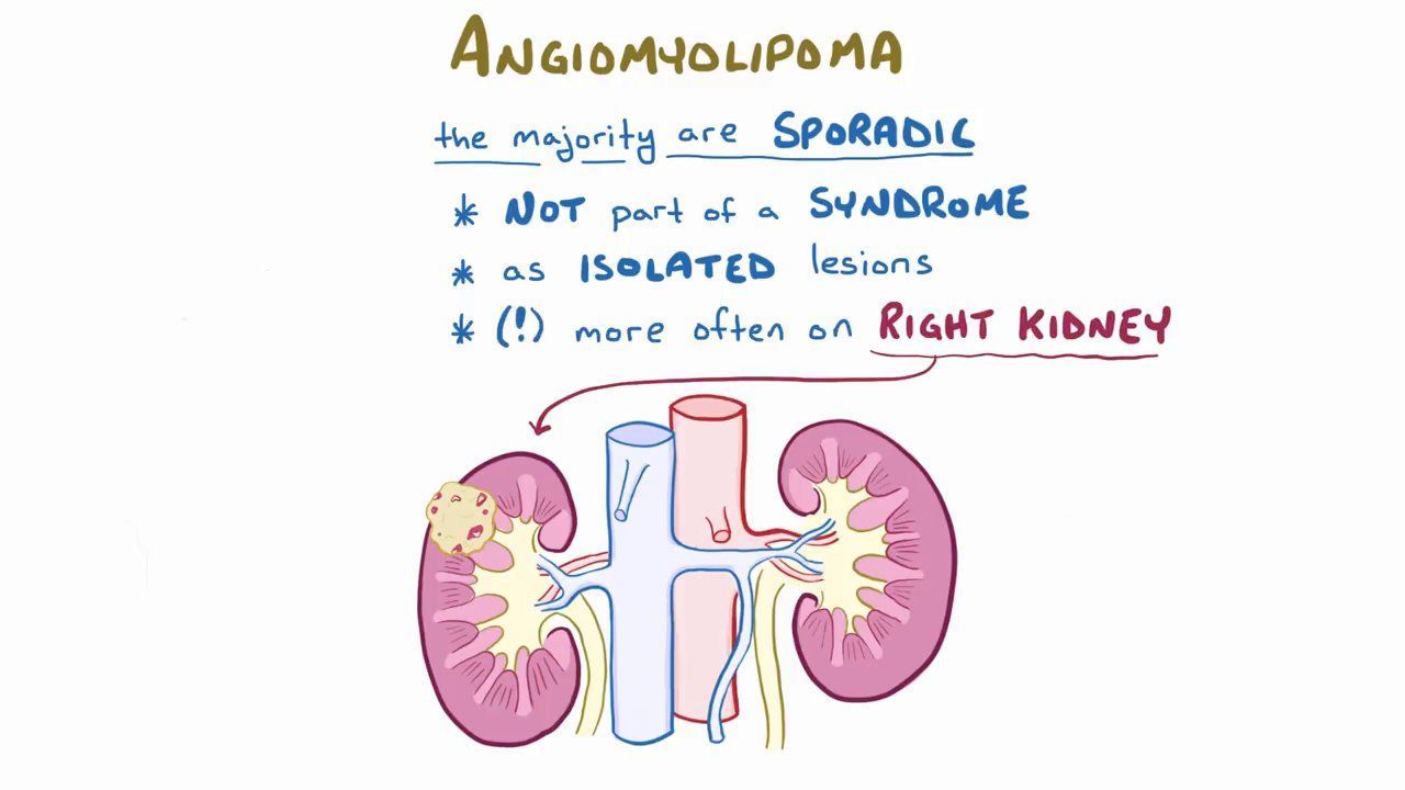 Video: Angiomyolipoma | Osmosis