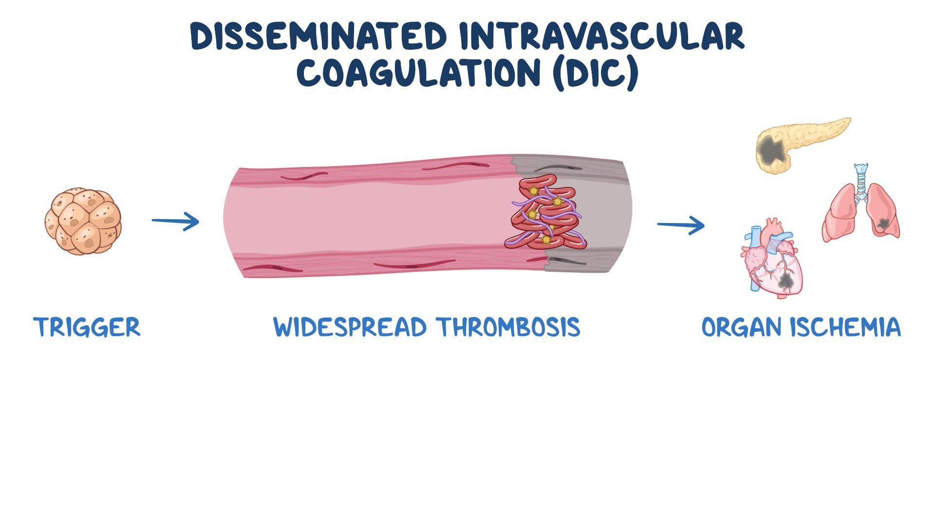 Video Disseminated Intravascular Coagulation Clinical Sciences Osmosis Video Disseminated Intravascular Coagulation Clinical Sciences Osmosis