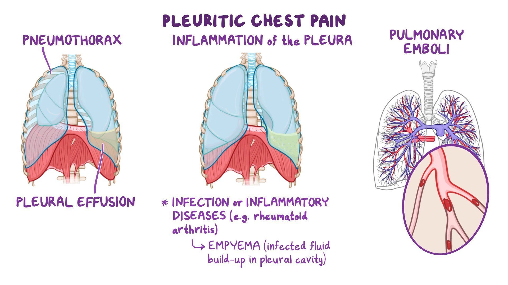 Pleurisy What Is It Causes Symptoms And More Osmosis