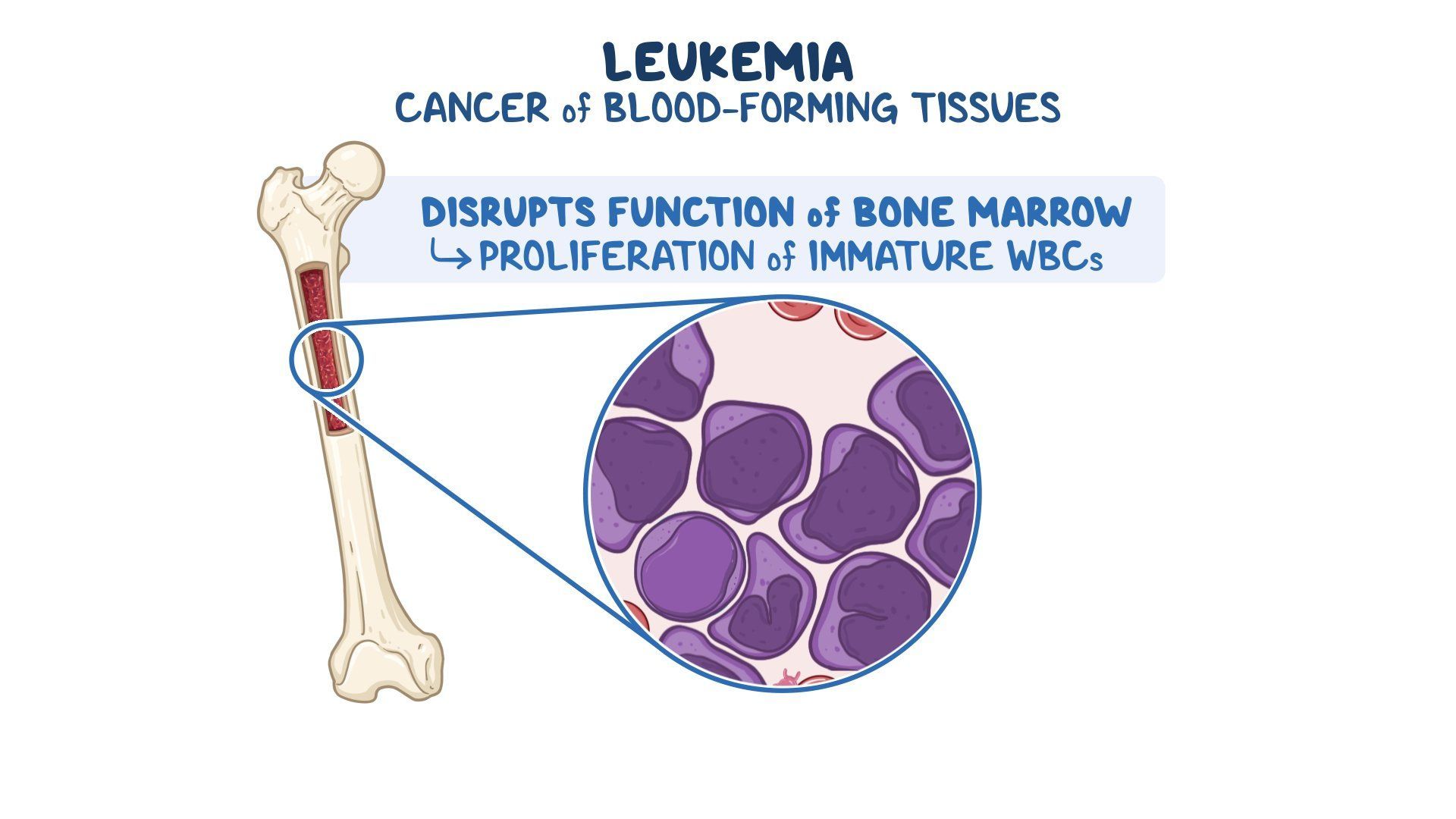 Video: Leukemia: Nursing pathophysiology | Osmosis