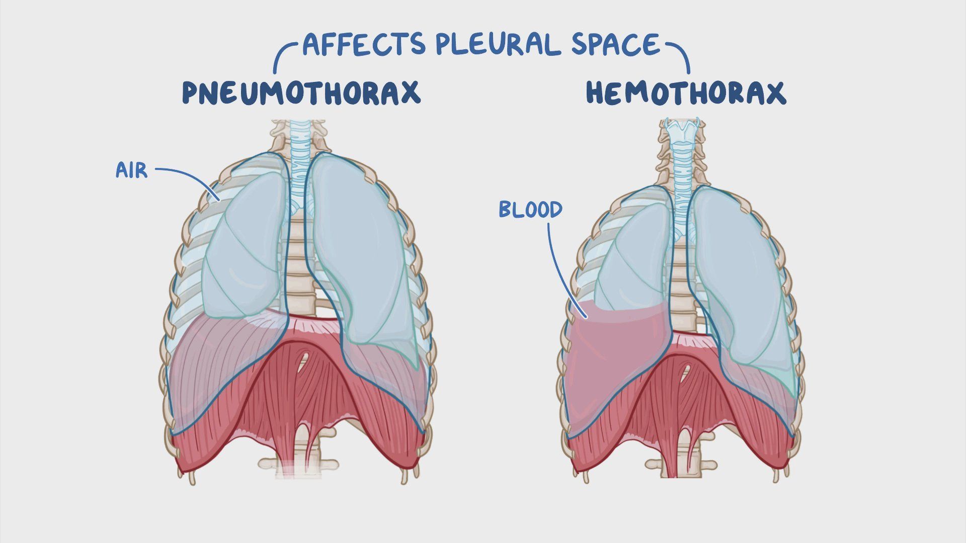Video Pneumothorax And Hemothorax Nursing Osmosis Video Pneumothorax And Hemothorax Nursing Osmosis