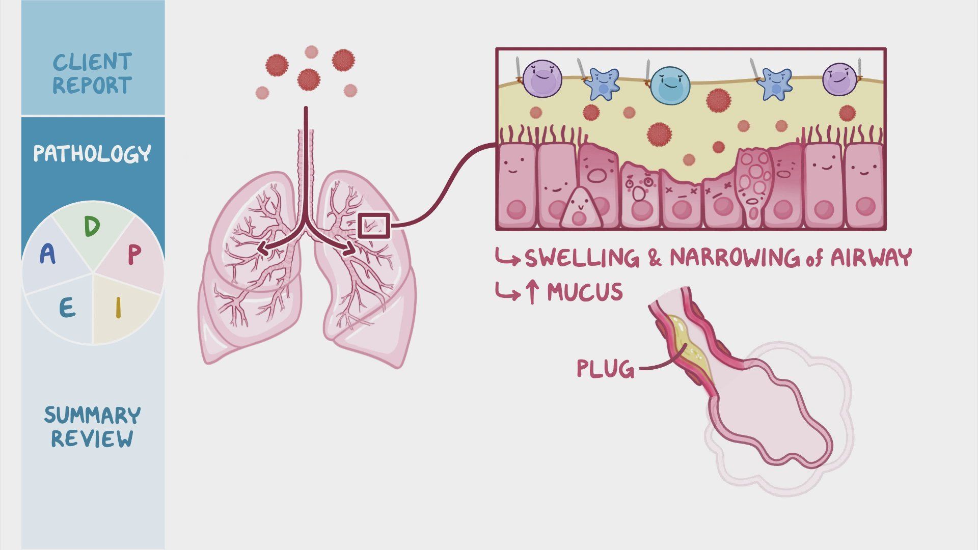 Video: Bronchiolitis and respiratory syncytial virus (RSV): Nursing process (ADPIE) | Osmosis