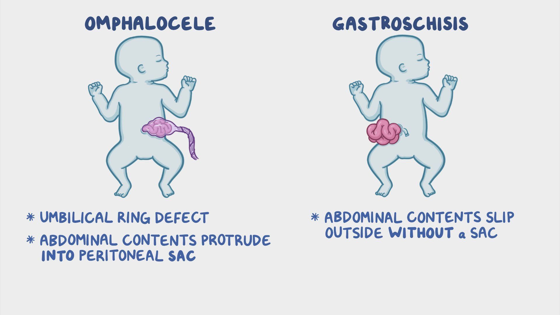Video: Omphalocele and gastroschisis: Nursing | Osmosis