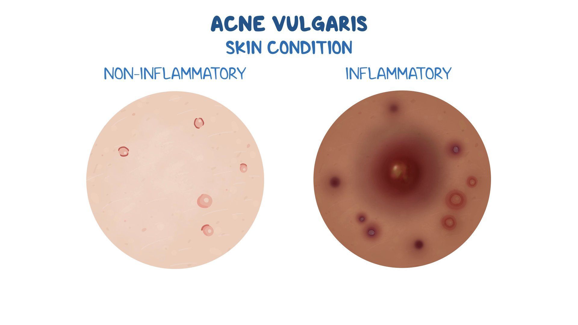 Video: Acne | Osmosis