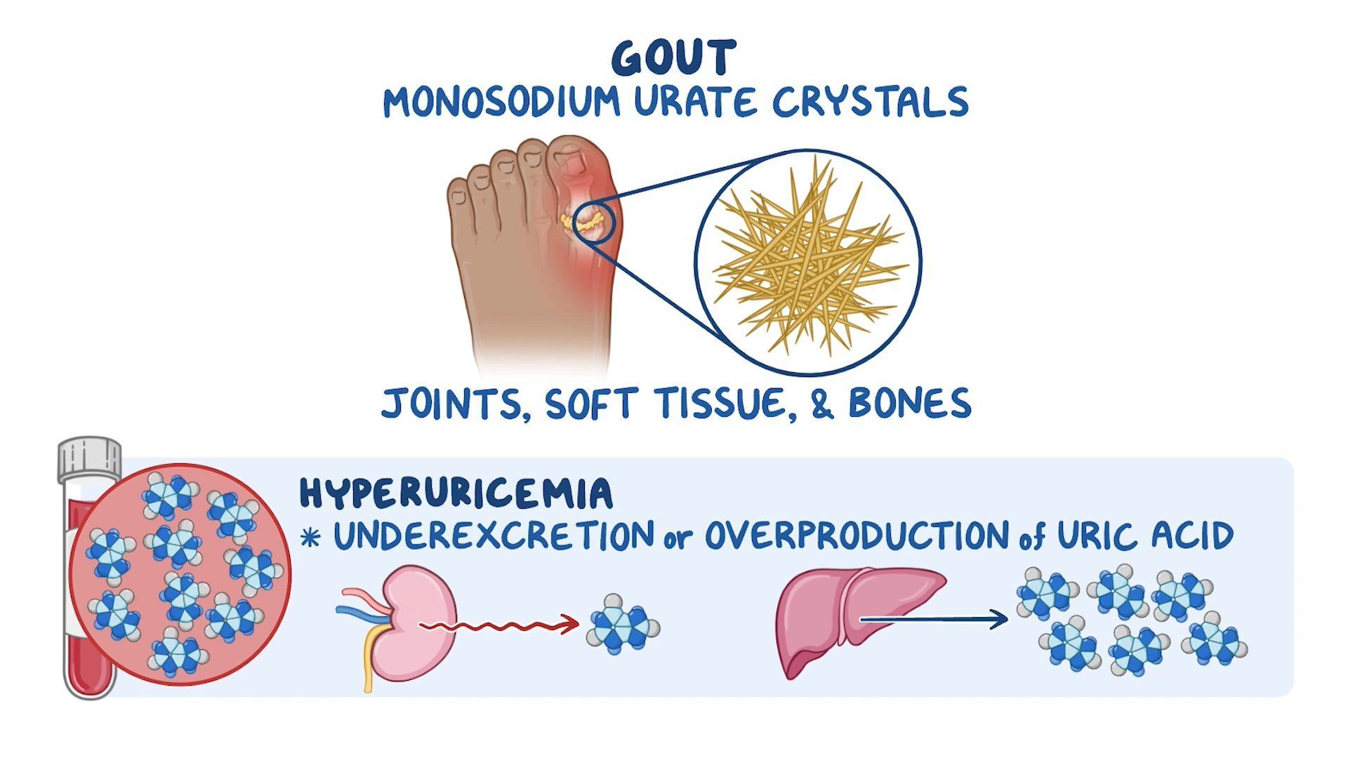 Video: Gout: Clinical sciences | Osmosis
