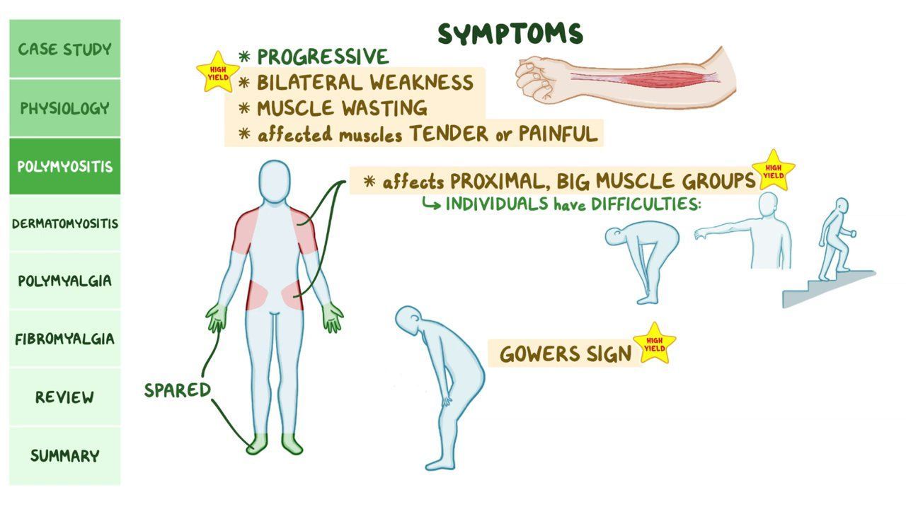 Myalgias and myositis: Pathology review - Osmosis