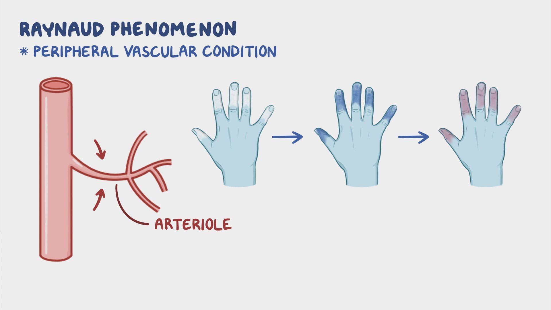 Video: Raynaud phenomenon: Nursing | Osmosis