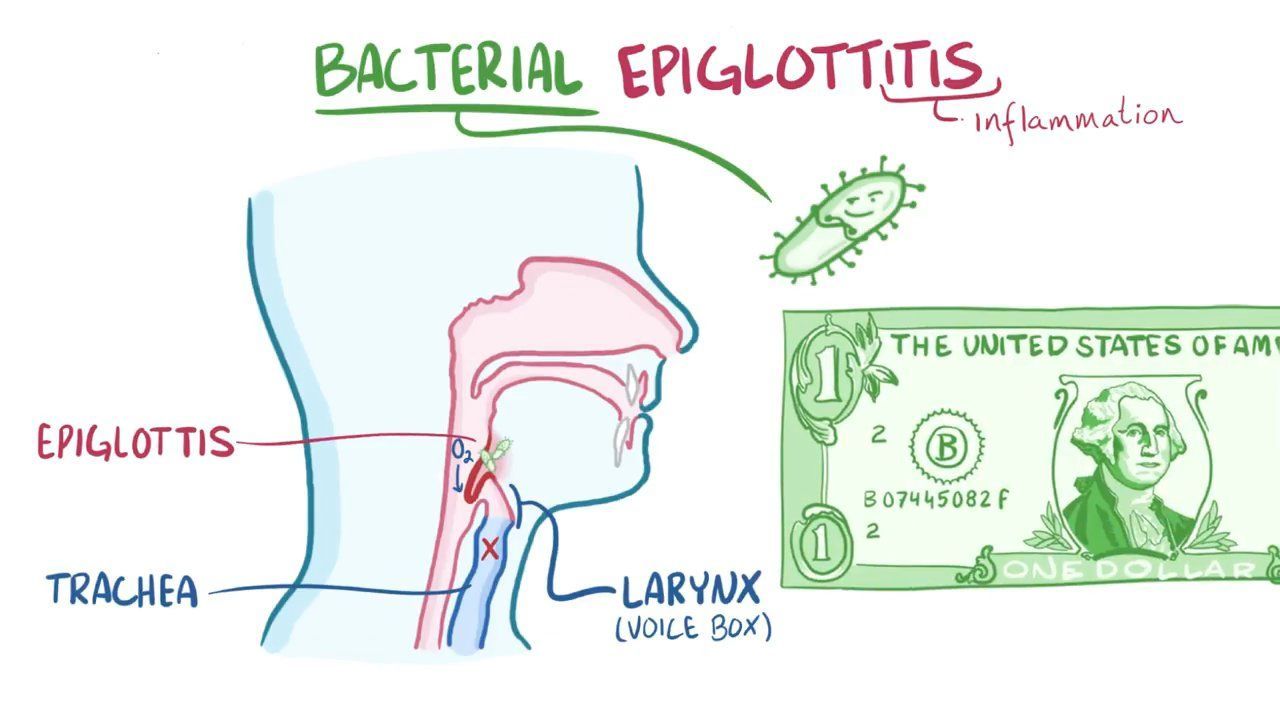 Video: Bacterial epiglottitis | Osmosis