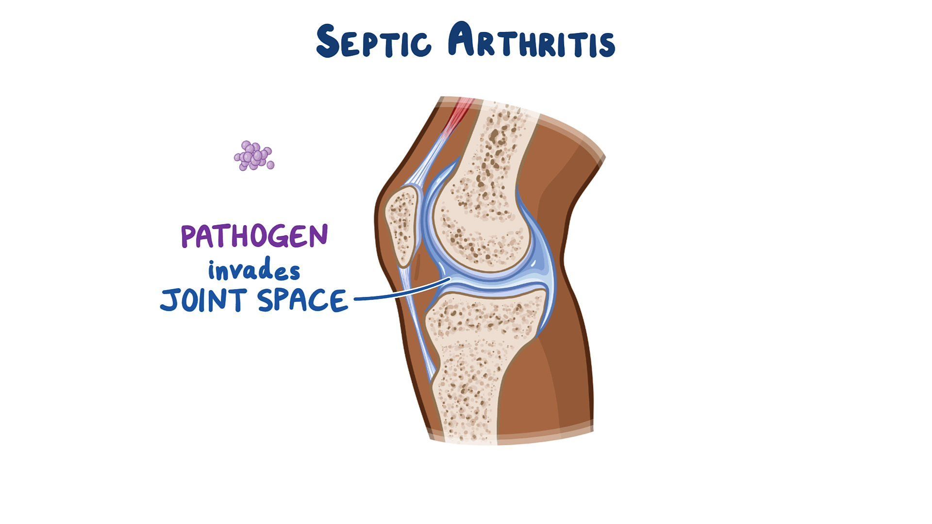 Video: Septic arthritis: Clinical sciences | Osmosis