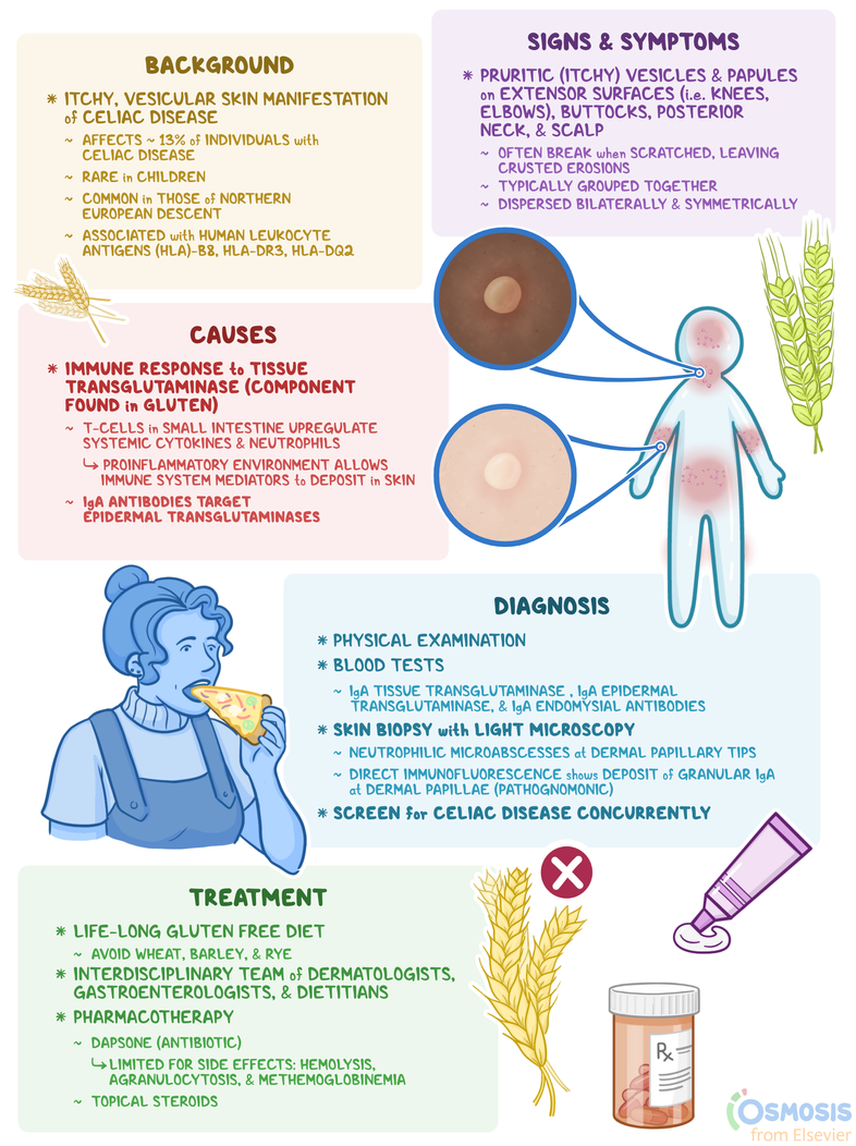 Dermatitis Herpetiformis: What It Is, Causes, Signs, and More | Osmosis
