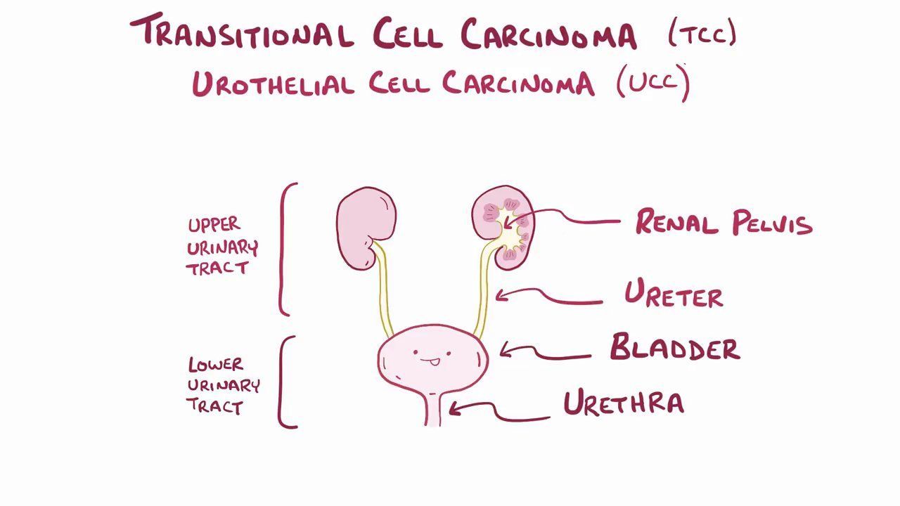 Video: Transitional cell carcinoma