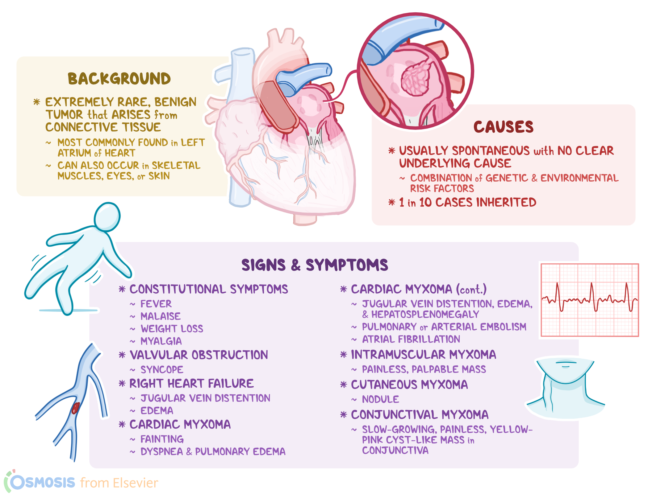 Myxoma: What Is It, Causes, Diagnosis, Treatment, and More | Osmosis