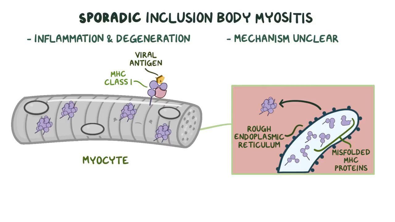 Video: Inclusion body myopathy | Osmosis