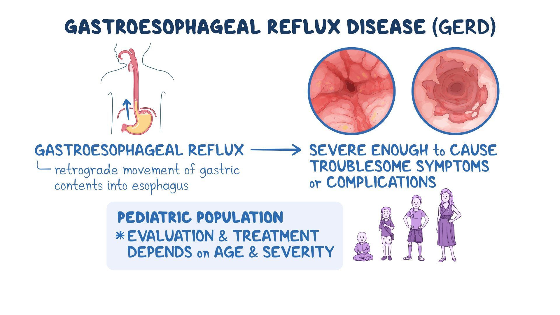 Video: Gastroesophageal reflux disease (pediatrics): Clinical sciences ...