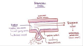 Vasculitis Notes: Diagrams & Illustrations | Osmosis