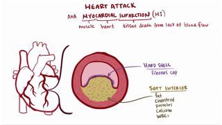 Acute coronary syndromes Notes: Diagrams & Illustrations | Osmosis